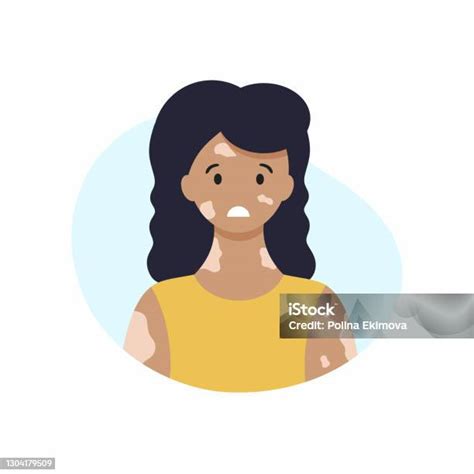 그녀의 얼굴과 피부에 Vitiligo와 슬픈 여자 세계 비틸리고의 날 피부 질환의 치료 건강관리와 의술에 대한 스톡 벡터 아트