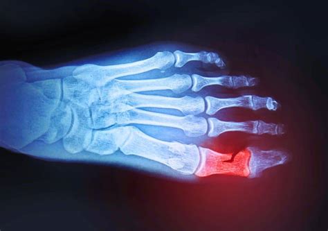 Orteil Cassé Diagnostic Traitement Temps De Guérison