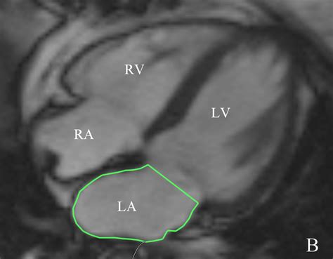 Figure 21 From Assessment Of Left Atrial Structure And Function In The Setting Of Atrial