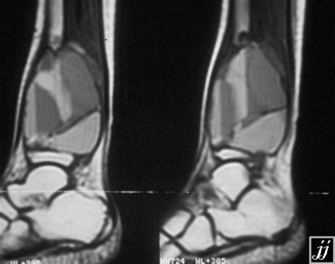 Msk Tibial Distal Abc Radioogle