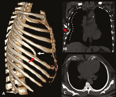 Brasil Anatomical Variations And Congenital Anomalies Of The Ribs