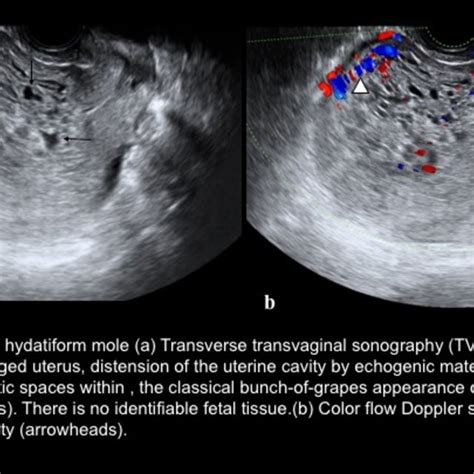 Complete Hydatiform Mole A Transverse Transvaginal Sonography Tvs