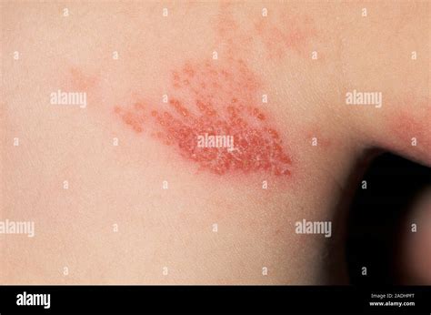Shingles Rash C8 Distribution On The Neck Of A Two Year Old Girl