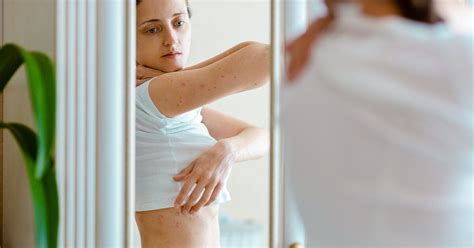 6 Ways Psoriasis Impacts Women