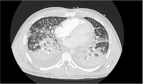 Ct Chest With Alveolar And Interstitial Edema Bilateral Posterior
