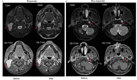 Representative Slice Of T2wi And Ce T1wi Of Metastatic Cervical Lymph Download Scientific