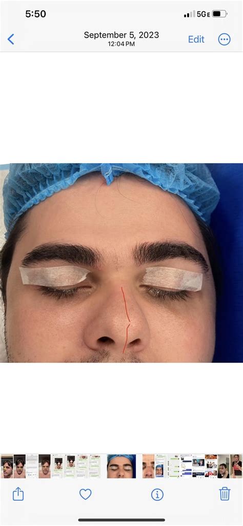 Bulbous Nose Rhinoplasty Rplasticsurgery