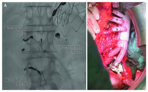 A Coil Embolisation Of Back Bleeding Spinal Cord Arteries Two Days