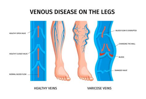 What Is Chronic Venous Insufficiency Nexgen Orthopedics
