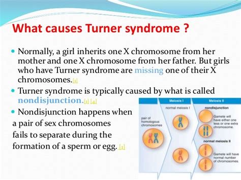 What Causes Turner Syndrome