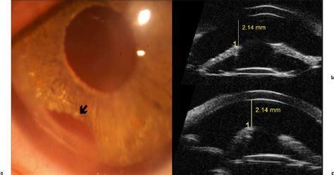 Iris Defects And Complications Ento Key