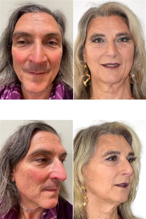 What Its Like To Undergo Gender Affirmation Surgery