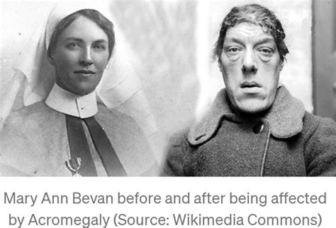 Mary Ann Bevan Before And After Being Affected By Acromegaly Source Wikimedia Commons Ifunny