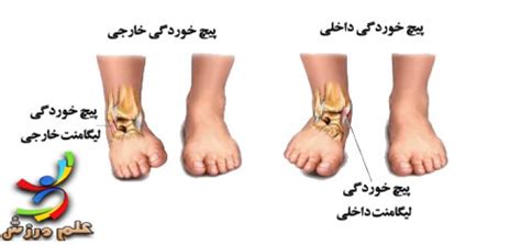 علم ورزش همه چیز درباره پیچ خوردگی مچ پا علت، علائم و روش درمان