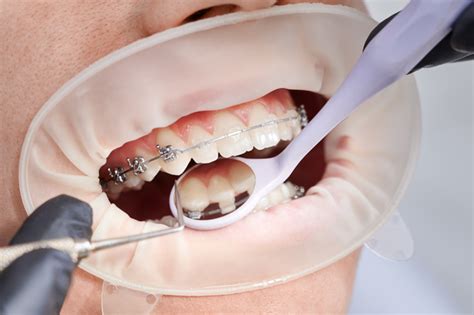 Traditional Braces Orthodontist In Ipswich And Brisbane