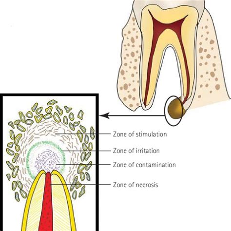 Endodontic Bacteria At Robin Walker Blog