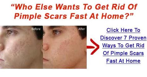 How To Get Rid Of Pimple Scars Fast Heal Acne Marks Easily