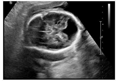 CH Fetal Neural Axis Flashcards Quizlet