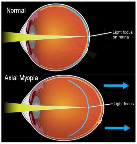 Myopia Sodium Chloride And Vitreous Fluid Imbalance A Nutritional