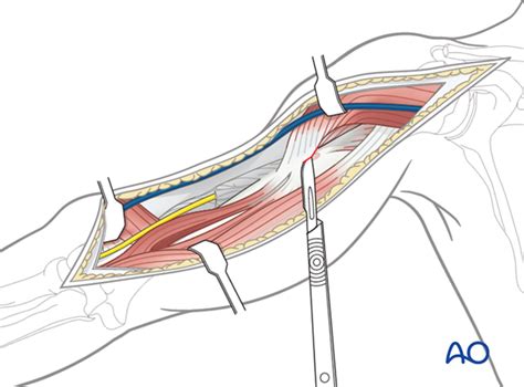 Anterolateral Approach To The Humerus After Henry