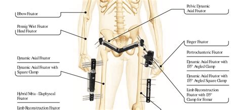 Ultimate Guide Of External Fixator Orthopromed Inc