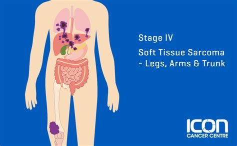 What Is Soft Tissue Sarcoma Soft Tissue Sarcoma Explained Icon Cancer Centre