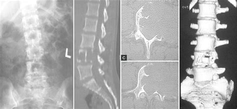 A X Ray Ap View Showing Lytic Lesion Involving The L4 Vertebral Body