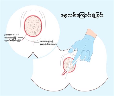 Episiotomy မွေးလမ်းကြောင်းချဲ့ခြင်း Cll Health