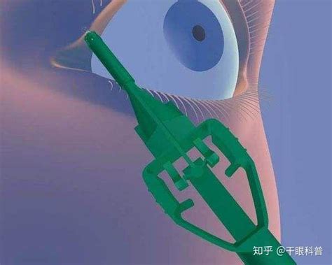 干眼症丨1分钟治疗干眼症，泪小点栓塞术是中重度干眼的治标之选 知乎