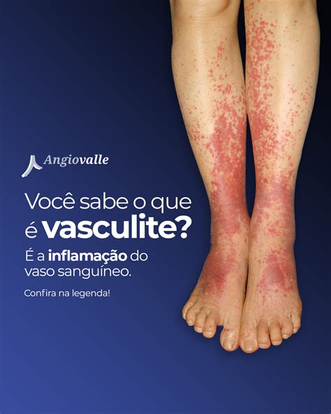 Você Sabe O Que é Vasculite Angioviva