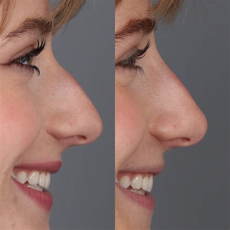 Liquid Rhinoplasty Before And After Photos The Vila Institute For