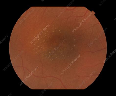 Crystalline Maculopathy Stock Image C030 7012 Science Photo Library