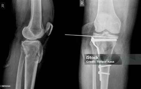 Gambar Xray Knee Menunjukkan Fraktur Proksimal Tibai Dan Perangkat