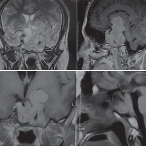 The Pituitary Tumor Filling The Sphenoid Sinus Before Bromocriptine A