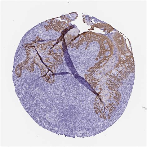 Tissue Expression Of Krt13 Staining In Tonsil The Human Protein Atlas