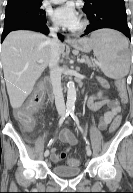 Typhlitis In A Post Chemotherapy Lymphoma Patient Images In Clinical Medicine Ecancer
