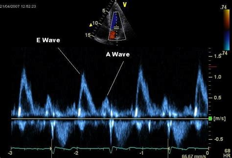 12 Mitral Inflow Pulsed Wave Doppler Download Scientific Diagram