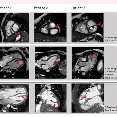 Presentation Of Double Chambered Left Ventricle In Cardiovascular Download Scientific Diagram
