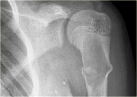The Radiology Assistant Osteolytic Well Defined Bone Tumors