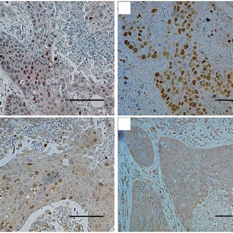 Representative Immunohistochemistry Findings For A Lung Tumor A Lung