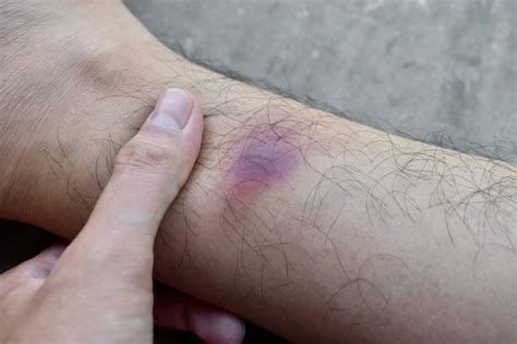 Strep Throat Rash On Legs