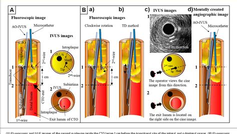 Figure From Tip Detectionantegrade Dissection And Re Entry With New