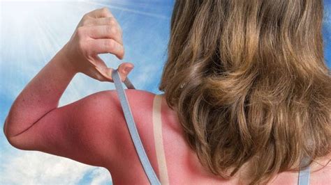 3 Ways To Get Rid Of A Sunburn Quickly Natural Remedies For Sunburn