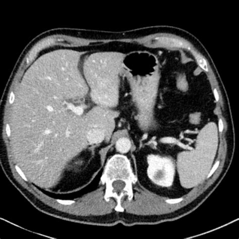 Cholangitis Ct