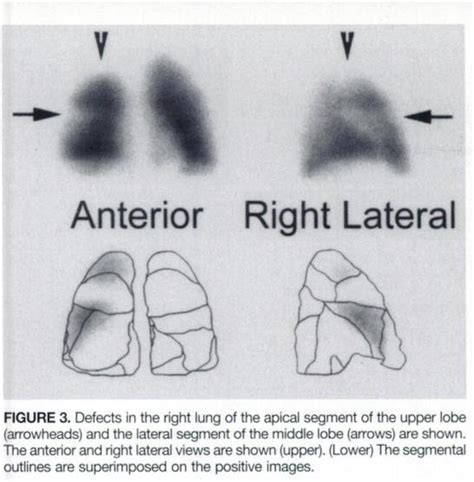 Defects In The Right Lung Of The Apical Segment Of The Upper Lobe
