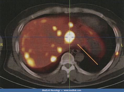 Micturition Syncope And Defecation Syncope Medlink Neurology
