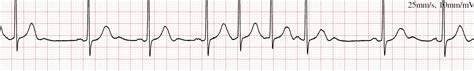 Ventricular Ectopy