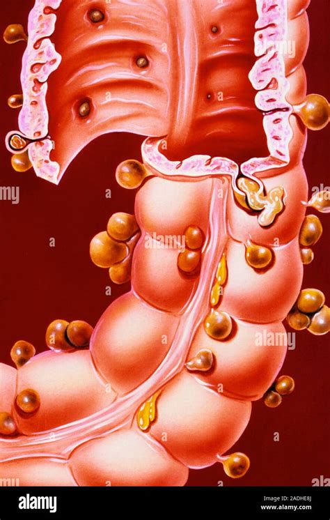 Diverticulitis Illustration Of A Region Of The Descending Colon Of The