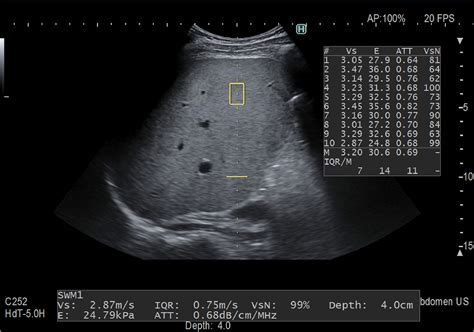 Fatty Liver Ultrasound