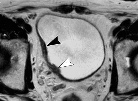 Dwi As An Imaging Biomarker For Bladder Cancer Ajr